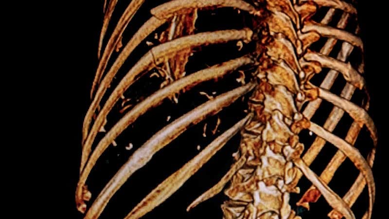 Syndrome de sevrage néonatal : une approche de soins centrés sur la ...