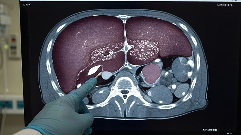 Panniculite mésentérique : un diagnostic scanographique