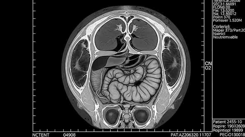 Panniculite mésentérique : un diagnostic scanographique
