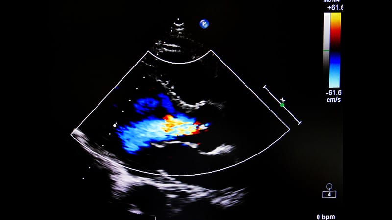 Insuffisance cardiaque : deux profils distincts d'insuffisance mitrale ...