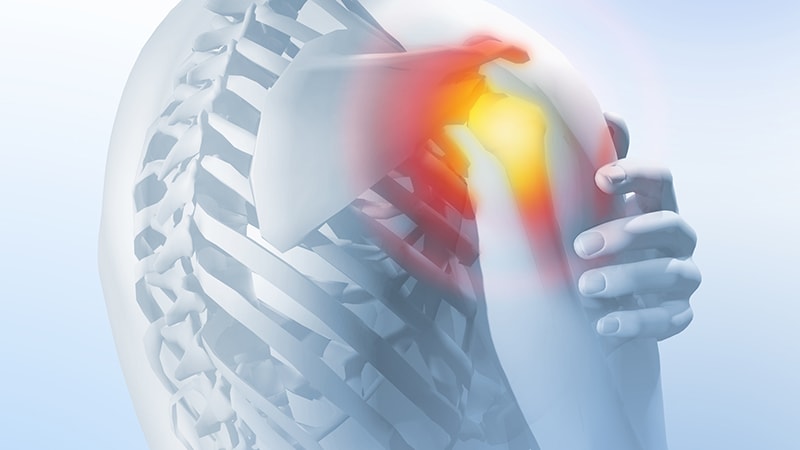 Syndrome douloureux sous-acromial : la décompression arthroscopique n ...