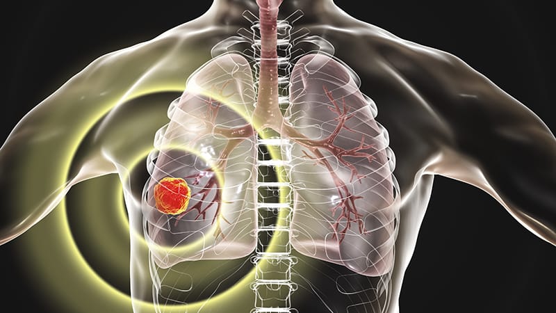 Cancer bronchique métastatique : pourquoi les traitements ne sont pas ...