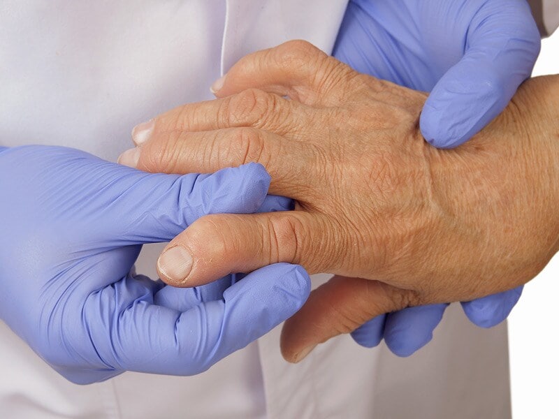 NICE Recommends Filgotinib for Moderate to Severe Active RA