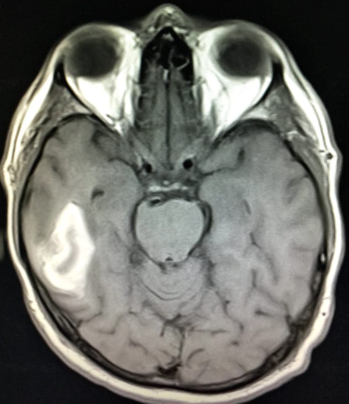 Trauma crânien : quels paramètres prédictifs de l’évolution en soins ...