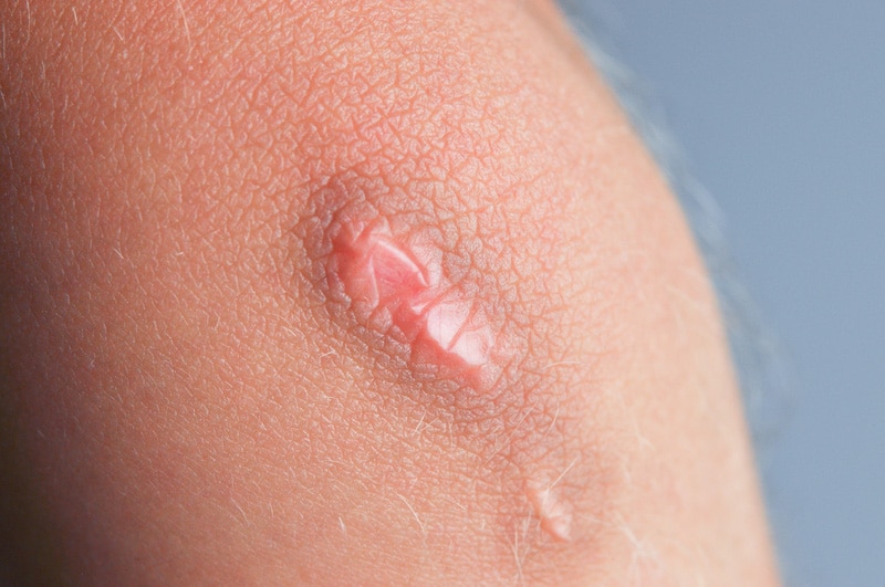 Prédire en temps réel le risque d’escarre grâce à l’IA