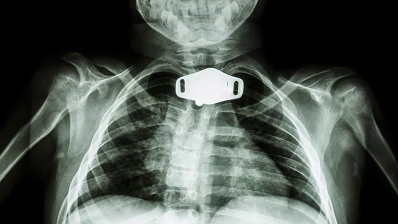 Micrognathie congénitale : isolée ou non