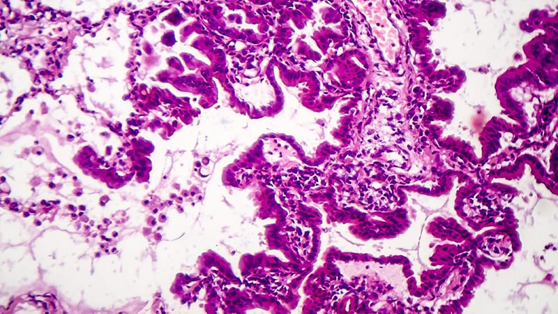 Adénocarcinome pulmonaire in situ : la progression est sous-tendue par ...