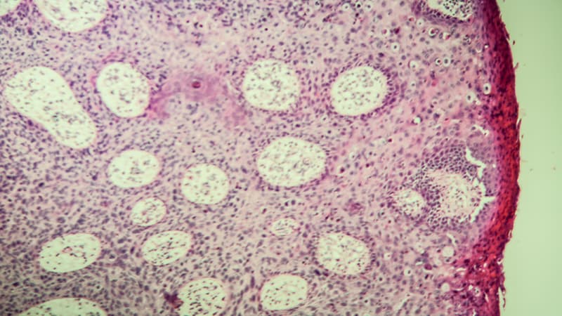 5-FU topique, une bonne alternative à la chirurgie pour traiter la ...