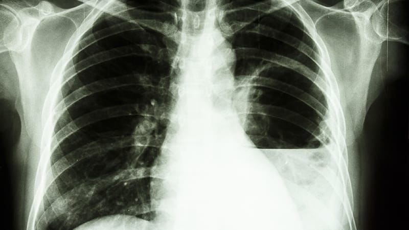 Portrait des abcès pulmonaires dans les réanimations françaises