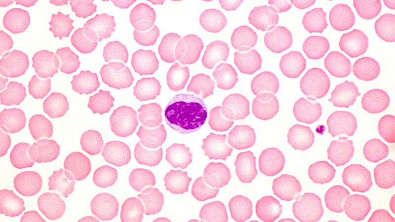 Diabète : évaluer le risque CV en dosant les monocytes