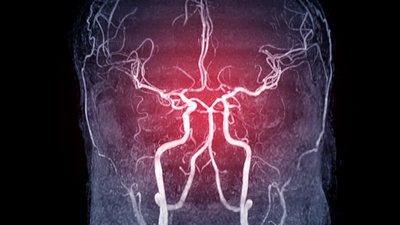 AVC ischémique : quelle place pour la thrombolyse « retardée