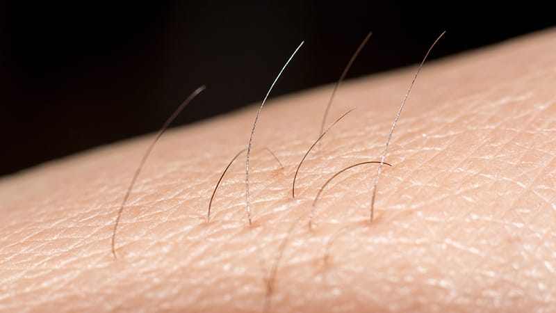 Epilation Laser pour la maladie pilonidale, la solution au poil