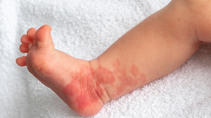 Hémangiomes infantiles et naevus congénital: quand et comment intervenir?