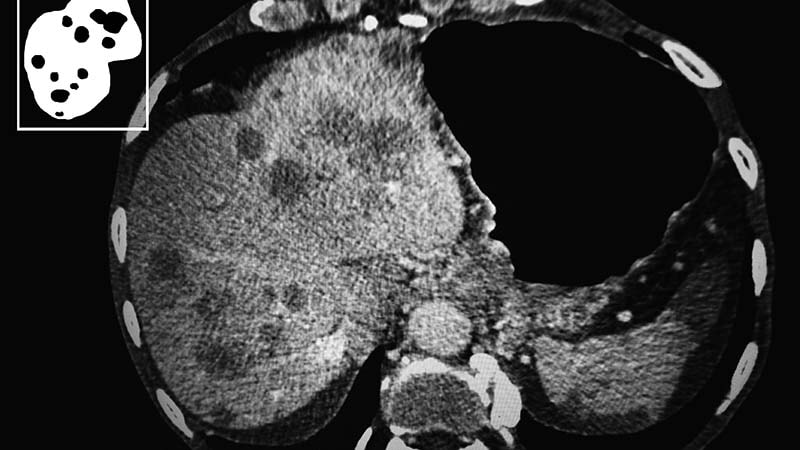 Adénocarcinome œsophagien à haut risque : ne dites plus CROSS mais FLOT