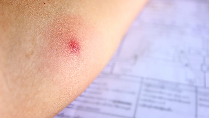 Dépistage et traitement de l’infection tuberculeuse latente de l’adulte