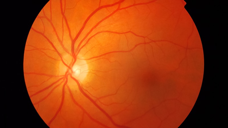 Eine junge Frau mit bilateralem Full-thickness-macular-hole