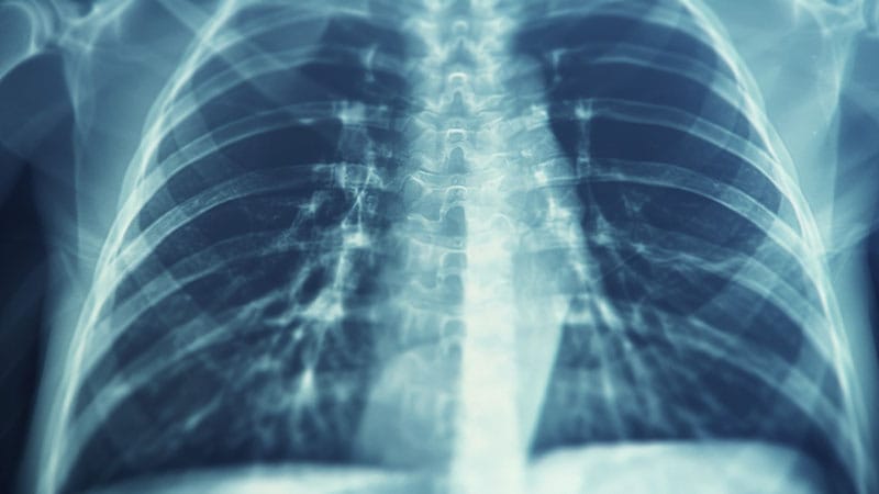 La bronchectasie à l’heure du dépistage du cancer bronchopulmonaire