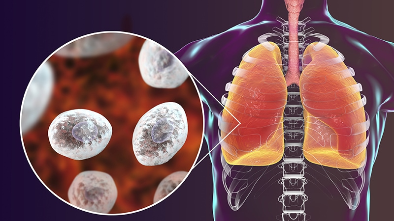 Différentes pneumonies à Pneumocystis jirovecii selon la pathologie ...