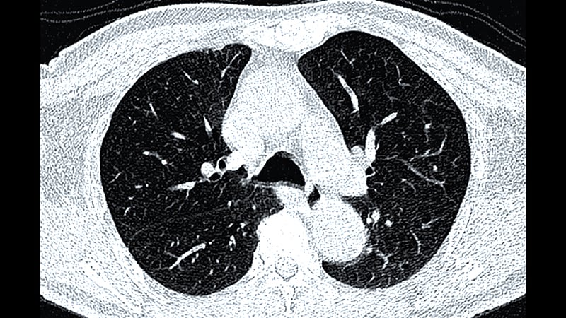 Dépistage du cancer bronchique : une pléthore de nodules pulmonaires…