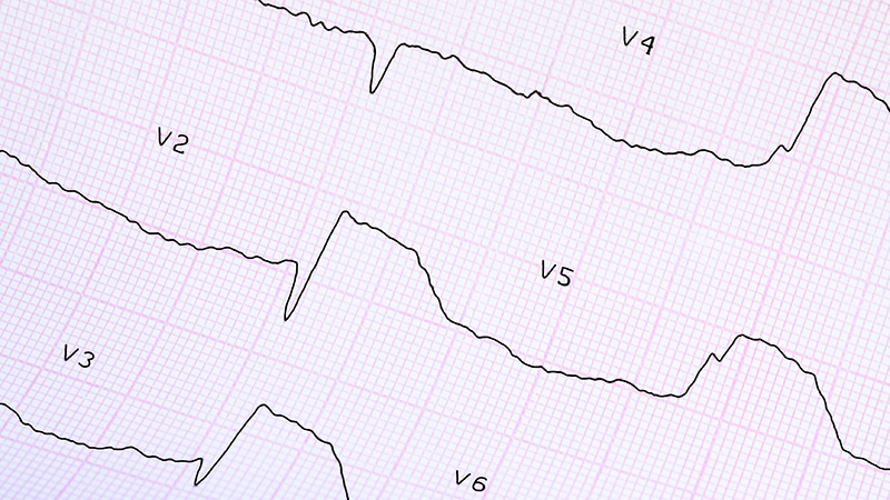 IDM chez les patients avec LMC : des cas pas si particuliers