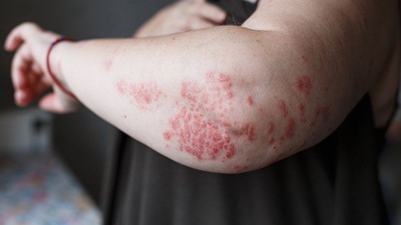 Guérir le psoriasis avec de nouveaux traitements