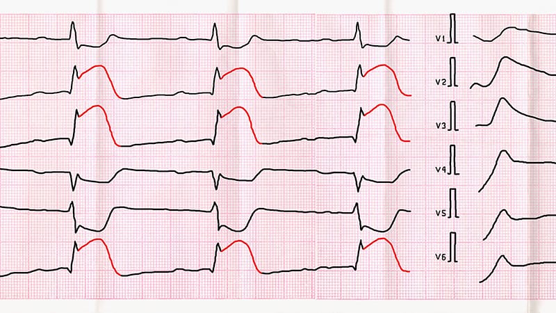 Au-delà de l'infarctus, la valeur pronostique de la troponine dans l ...