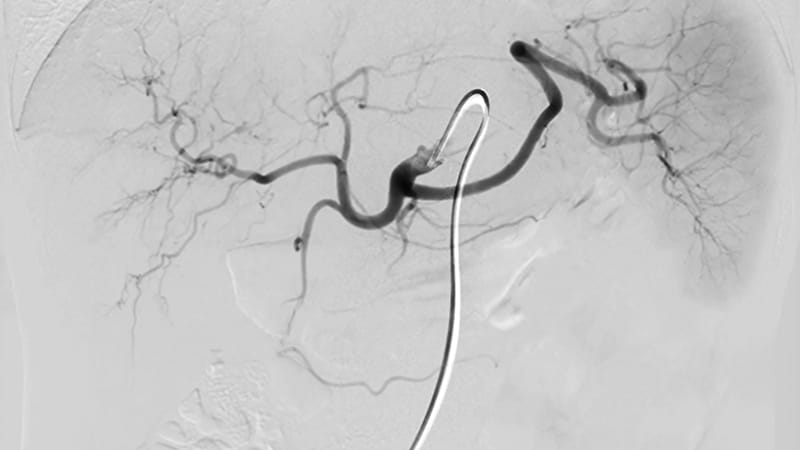 Embolisation artérielle des hémorragies du grêle : quelles sont les ...