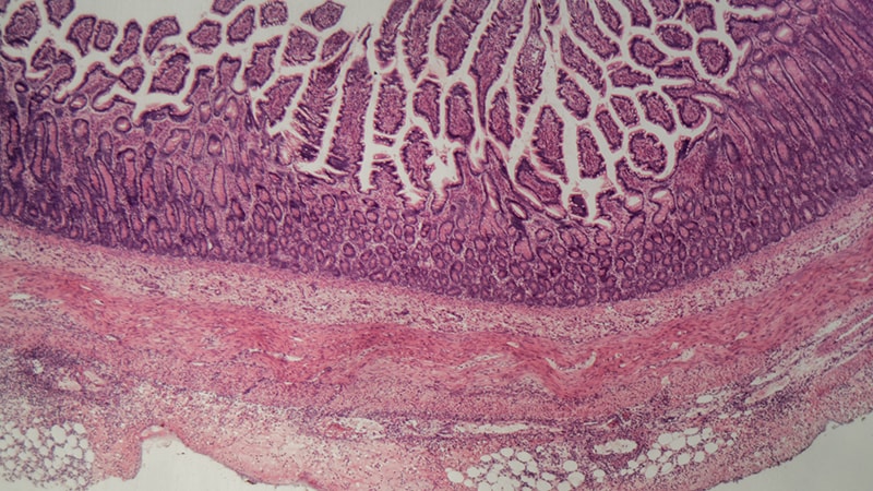 Colite microscopique : quelle prise en charge en population gériatrique