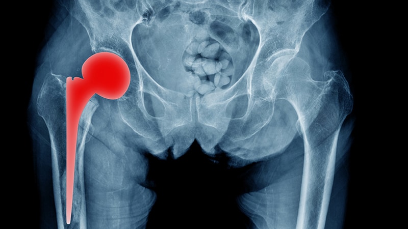 Coxarthrose : ajouter une activité aérobie au renforcement musculaire