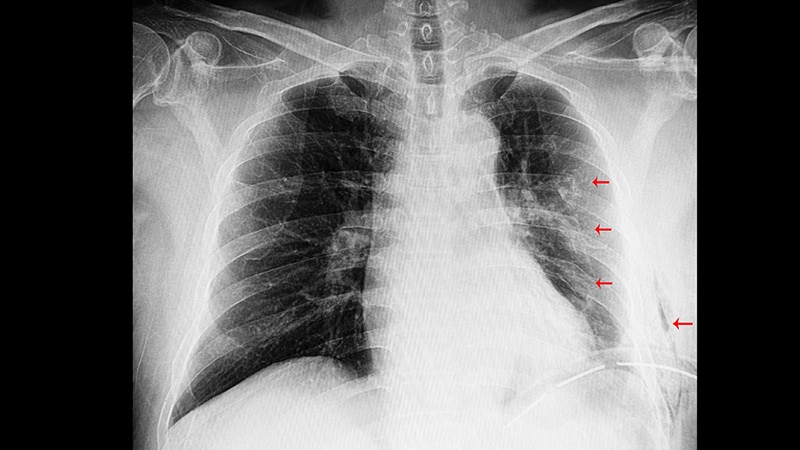 Radiografia De Torax Com Enfisema La Radiografía De Tórax Se Realiza