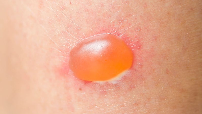 Du nouveau pour la pemphigoïde bulleuse