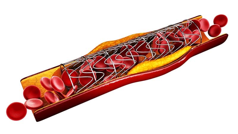 Stent actif : après la bithérapie, le clopidogrel confirme l’essai