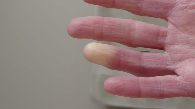 Intérêt du linerixibat sur le prurit de la cholangite biliaire primitive