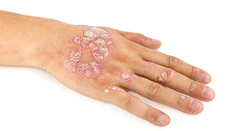 Une relation viscérale entre obésité et psoriasis