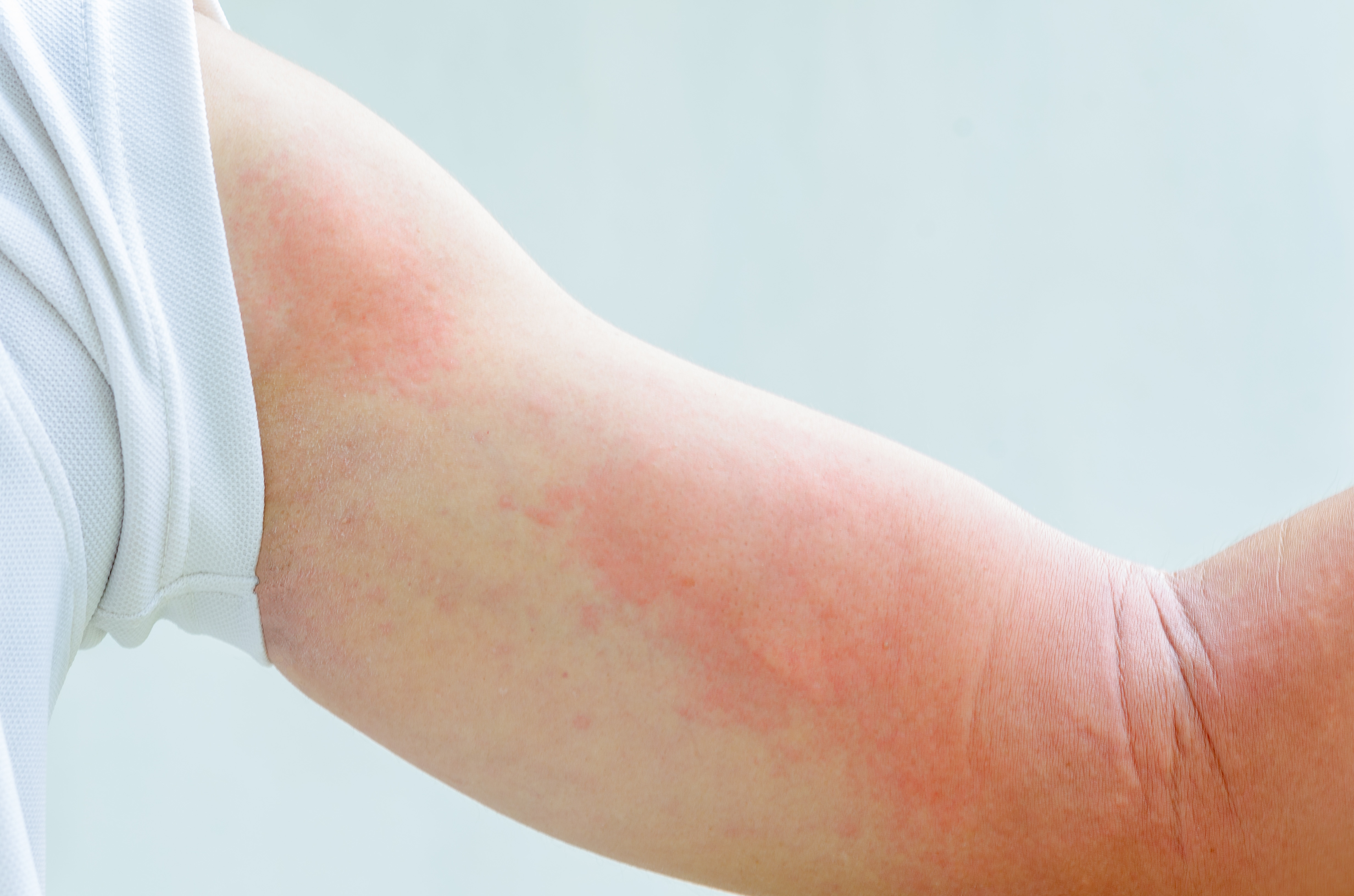 COVID-19: skin rashes may hold key to diagnosis
