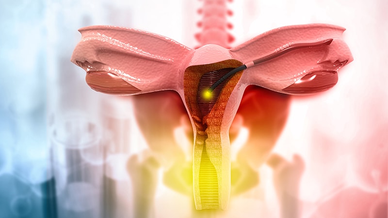 Simple or Radical Hysterectomy for Low-Risk Cervical Cancer?