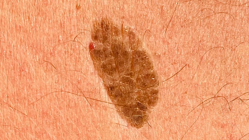 High-Res Skin Imaging Expansion 'to Speed Cancer Diagnoses'