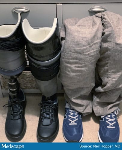 Sepsis Amputation Surgeon: What I Learned After Losing My Legs