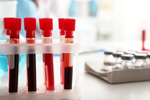 New BSG guideline on iron deficiency anaemia