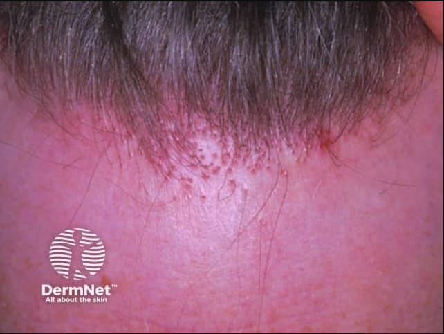 Alopecia: PCDS 2024 Guideline Expert Insight