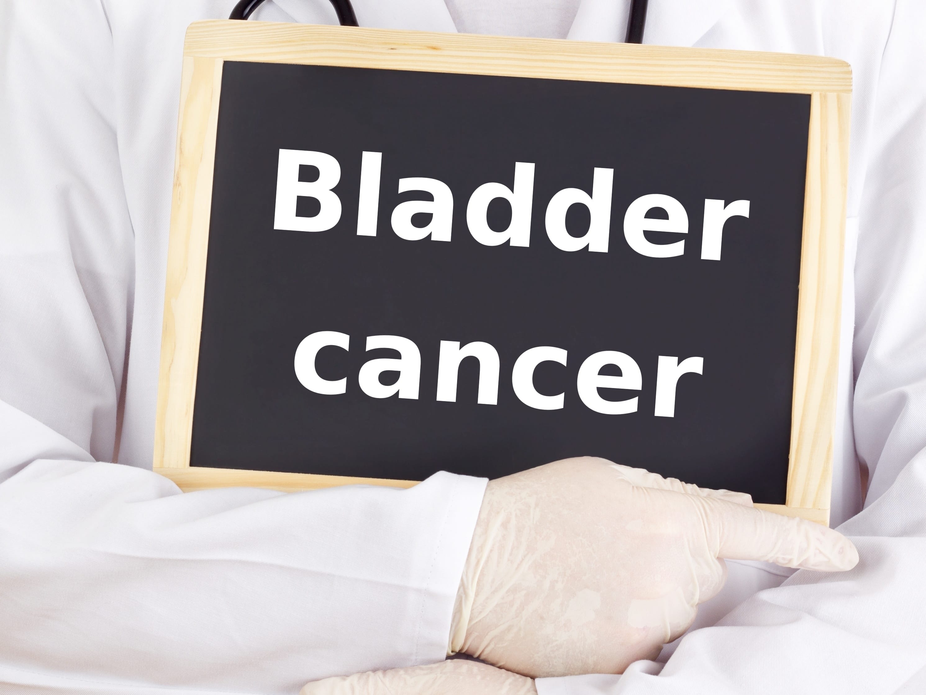 Urine test to monitor bladder cancer treatment could be on the horizon