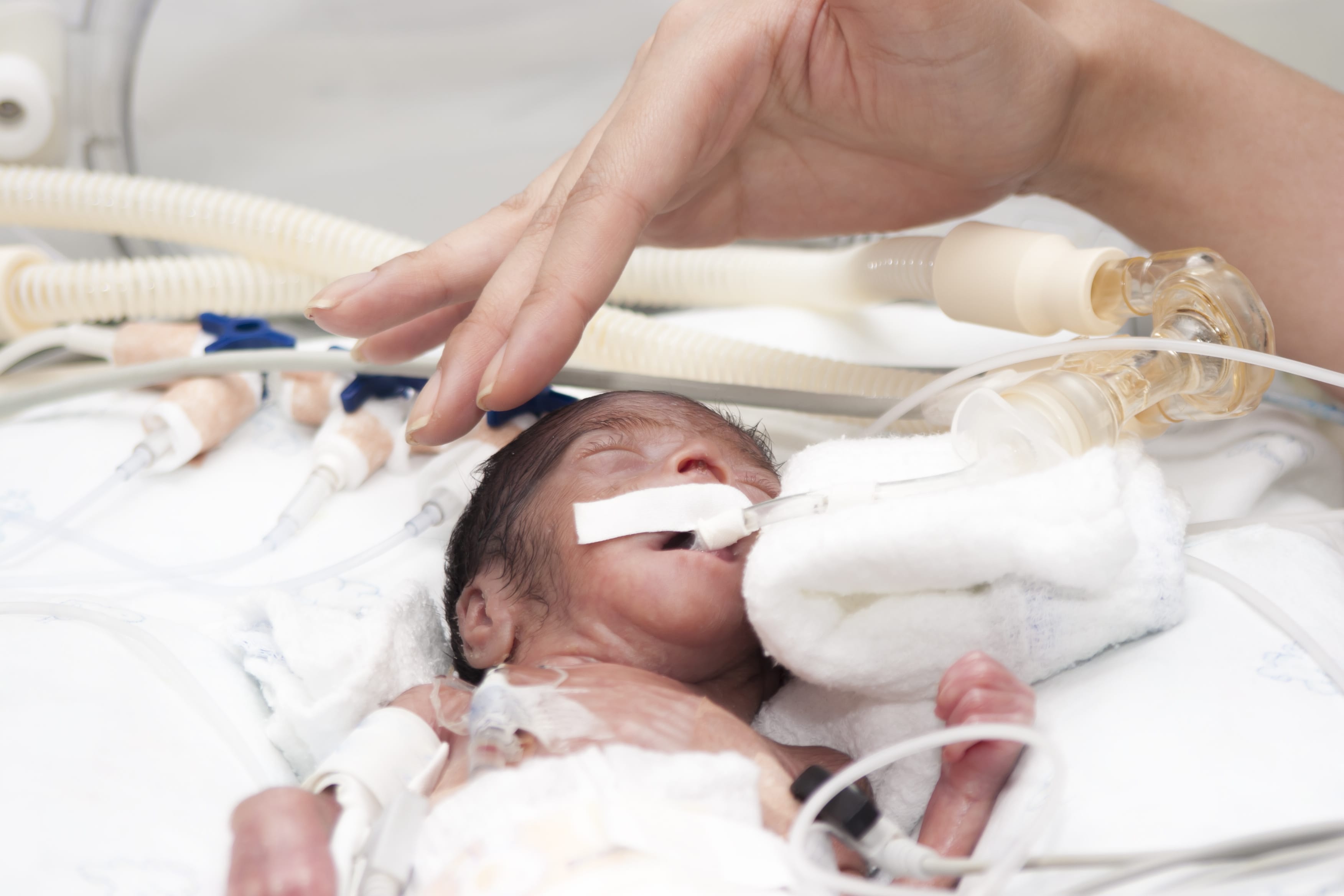 New trial to determine the optimal way of feeding preemies