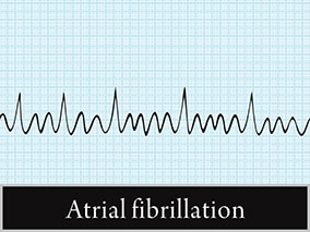 Patients with resolved Afib at 60% higher risk for stroke/TIA vs those ...