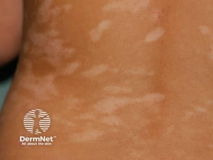 Top Tips: Atopic Dermatitis in Skin of Colour