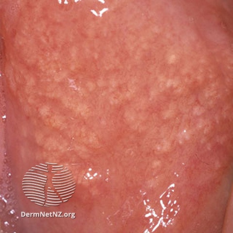 Top Tips: Vulval Dermatoses