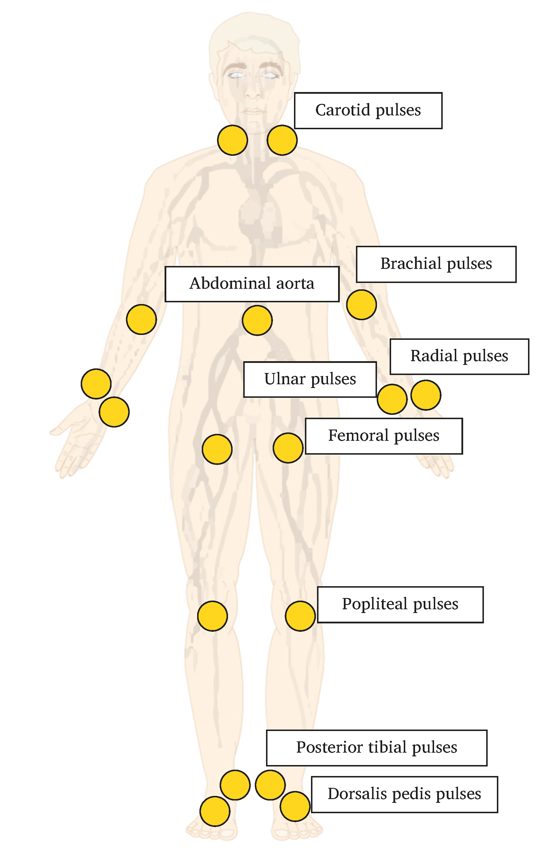 Peripheral Arterial and Aortic Diseases: ESC 2024 Guideline Summary
