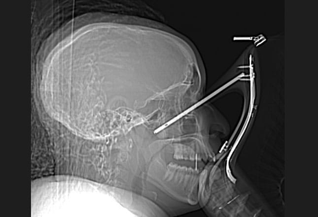 Foreign Bodies in the Head and Airways