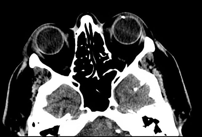 Foreign Bodies in the Head and Airways