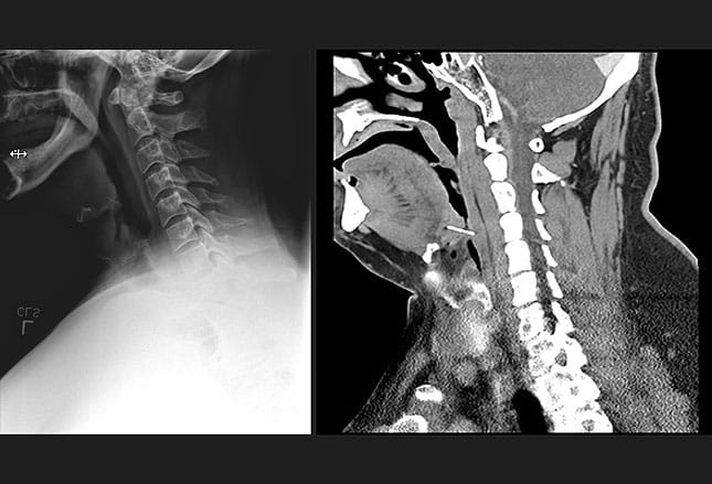 Foreign Bodies in the Head and Airways