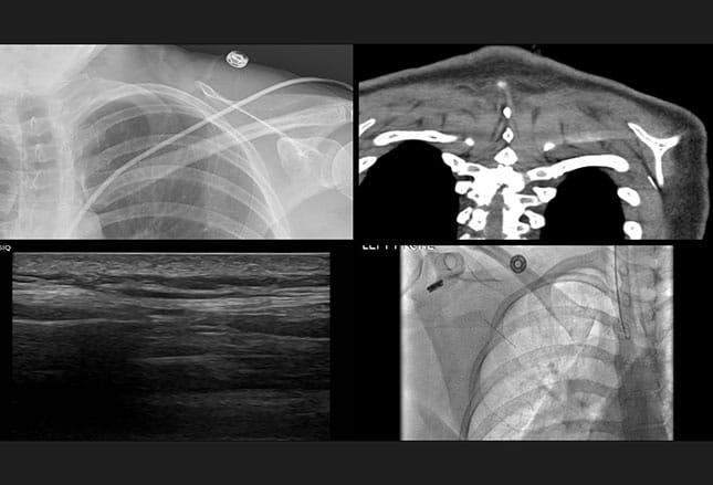 Foreign Bodies in the Head and Airways